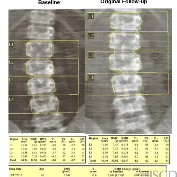 Spinal Level Identification - ISCD