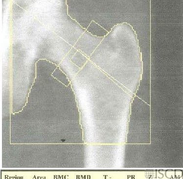 Spine Positioning and Rotation - ISCD