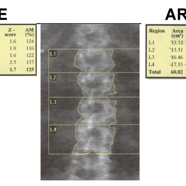 Incorrect Size of Lumbar Spine Region of Interest on A Hologic Lumbar ...