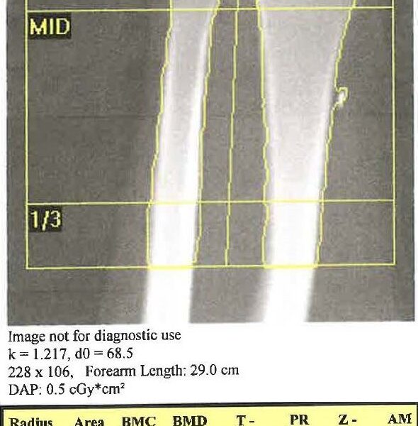 Common Iliac Stents - ISCD