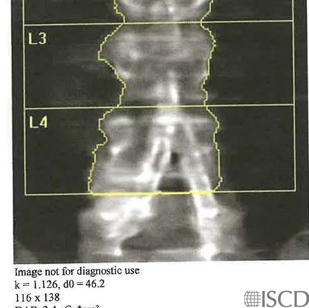 Common Iliac Stents - ISCD