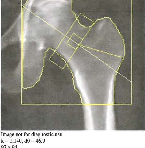 Common Iliac Stents - ISCD